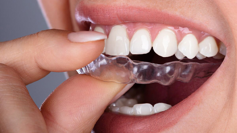 Bruxism: All You Need To Know About Teeth Grinding